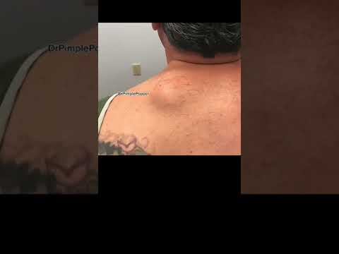 Lipoma Jiggle! #Shorts #drpimplepopper