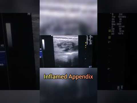 Ultrasound showing Inflamed Appendix💯