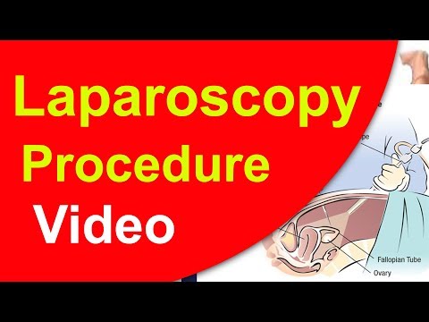லேப்ராஸ்கோபி அறுவைசிகிச்சை முறை| laparoscopy for infertility in tamil | IVF IUI ICSI Testtube baby