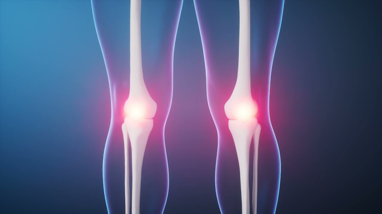 Alpha 2 Macroglobulin (A2M)