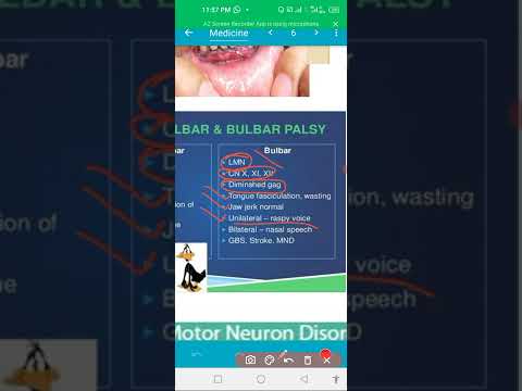 Bulbar palsy vs Psuedobulbar palsy | Upper motor neuron | Lower motor neuron disease | Pathology
