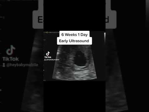 Heartbeat on Early Ultrasound at 6 Weeks 1 Day Pregnant