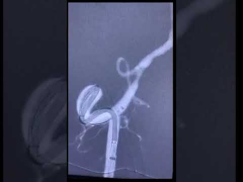 Stenosis of the right intracranial vertebral artery