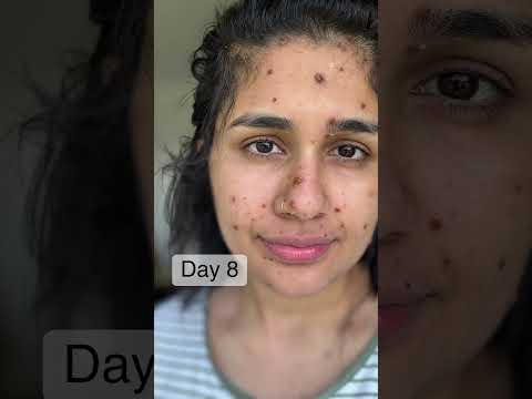 Chicken pox Days | This too shall pass #staystrong #nothingserious