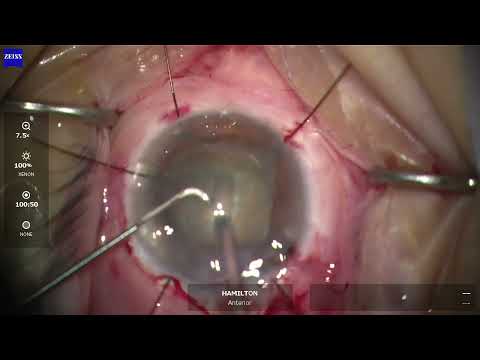 Cataract Surgery in Nanopthalmic Eye