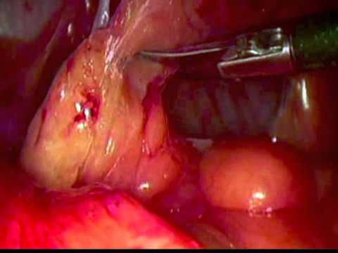 Lysis of abdominal wall and intestinal adhesions using scissors without electrosurgery before TLH