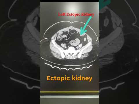Ectopic kidney #radiology
