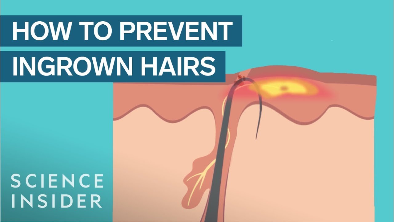 What Are Ingrown Hairs — And How To Treat Them