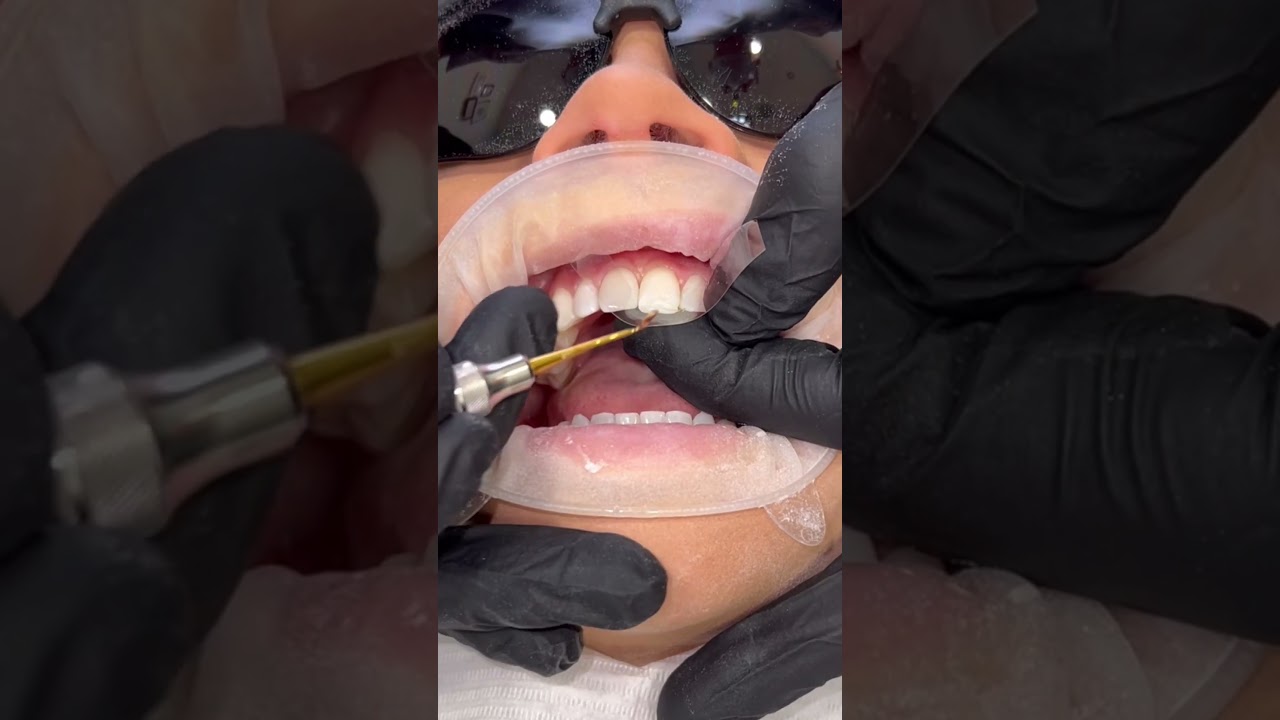 Composite bonding by Dr. Matt 😍 #ruhdental #compositebonding