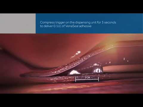 Dr. Stefan Franciosa talks vein treatment options including VenaSeal - Henderson / Las Vegas