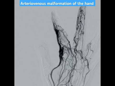 Angiography case 56: AVM of the hand #angiography #radiology #radiologist #mri #medical