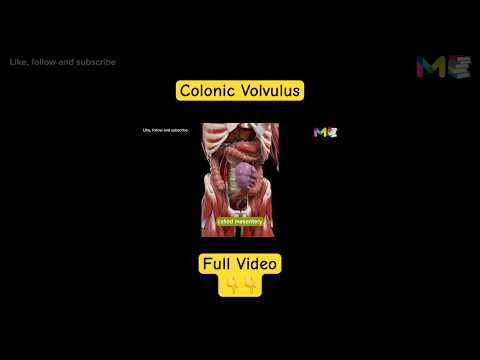 Colonic Volvulus #shorts #ColonicVolvulus
