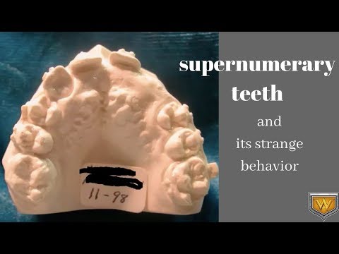 Supernumerary teeth and their strange behavior on developing dentition !!
