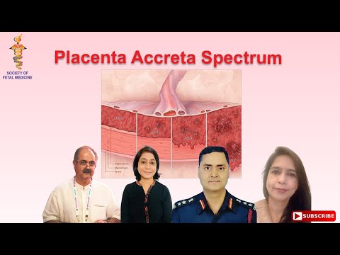 Placenta Accreta Spectrum