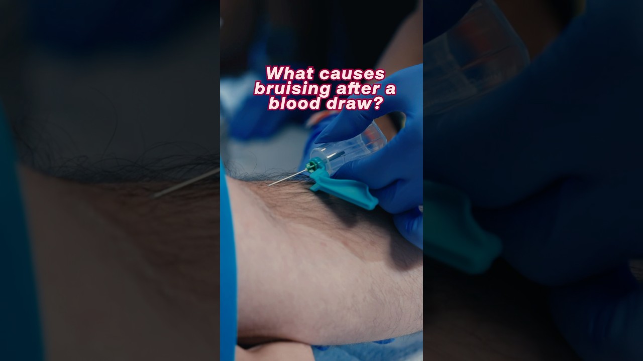 What causes bruising after a blood draw?