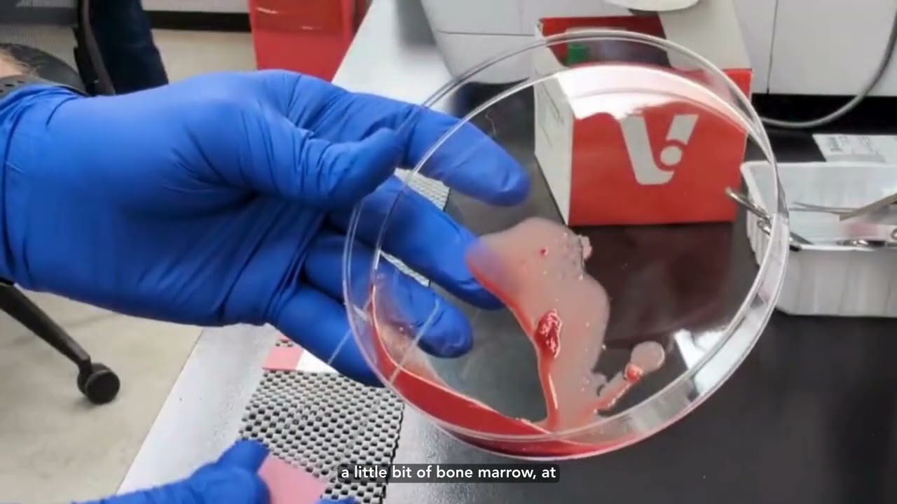 Bone Marrow: Direct Aspirate Smears Overview