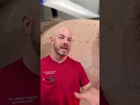 This is what ablative laser skin resurfacing looks like! (credit: @skinbydrazi)