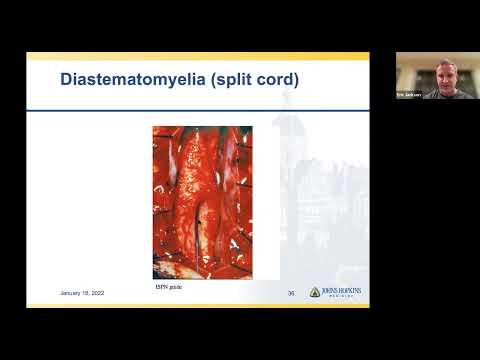 “Closed Spina Bifida: What is in a Name?”
