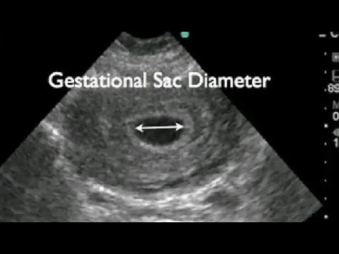 Early pregnancy gestational sac measurement