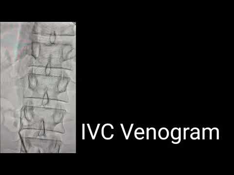 IVC Filter Placement in DVT to prevent pulmonary embolism live demostration by Dr Shaileshkumar