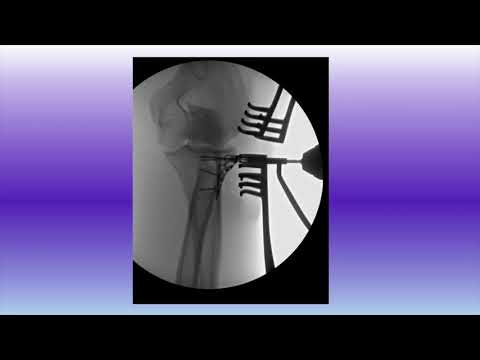 Radial Head Fractures - Trauma - Orthobullets