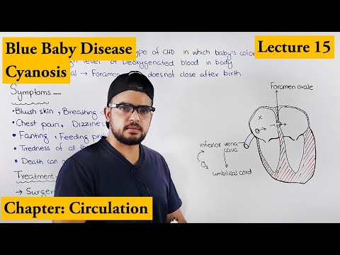 Cyanosis / Blue baby ( Cardiovascular disorders) | Chapter Circulation video 15
