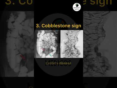 10 Radiology signs in Gastroenterology (Must know for exams) #radiology #gastroenterology #shorts