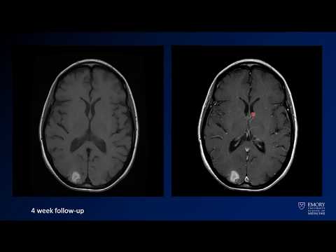Imaging intracranial hemorrhage - Case 3 - PRES - posterior reversible encephalopathy syndrome