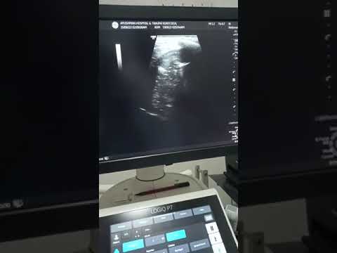 Air bronchogram ..chest ultrasound
