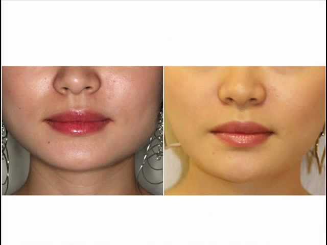 How Long Does Masseter Botox Take To Work - Photos Idea How Long Does Masseter Botox Take To Work - Photos Idea
