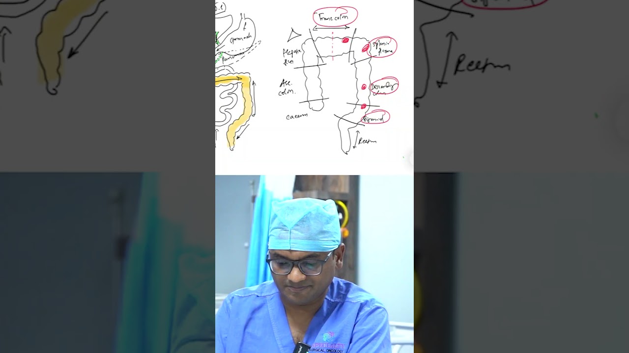 Step-by-Step Left Hemicolectomy: Understanding Colon Cancer Treatment | Dr Praveen Kammar