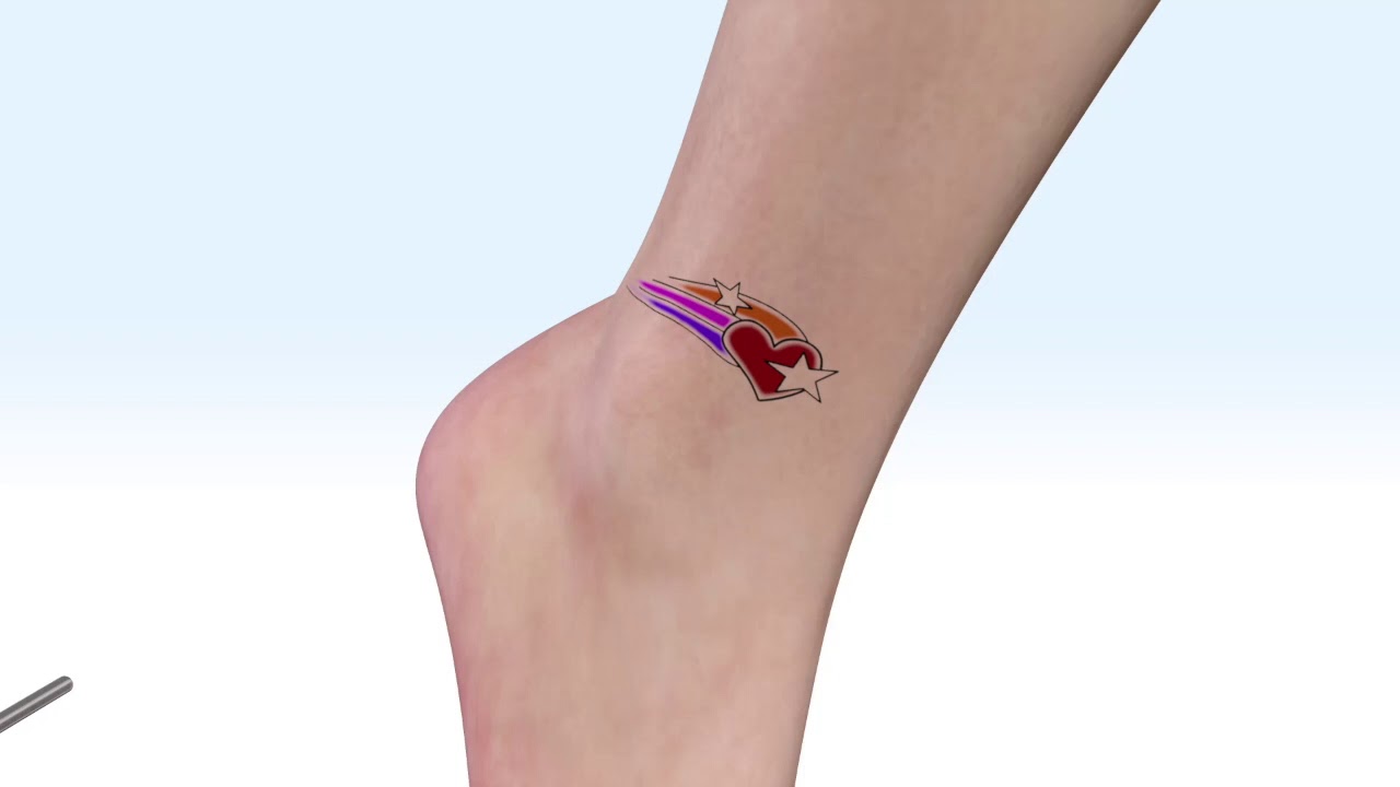 Astanza Duality High-Powered Tattoo Removal Laser