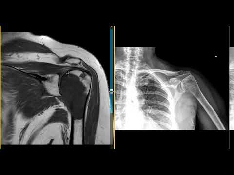 Bone tumor in humerus