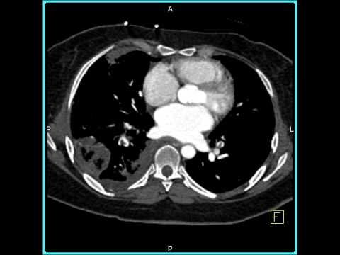 Lung Anatomy: Pulmonary Emboli & Infarcts Axial (1 of 4)
