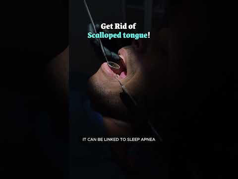 Get Rid of Scalloped tongue!