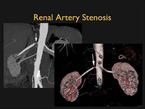 CTA of the Abdominal Aorta Branches: Select Pathologies Part 2