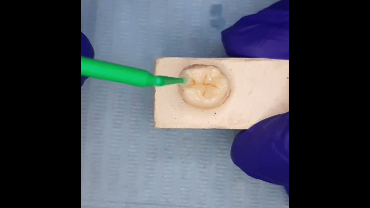 How to restore Class I in very easy way( Fast Modeling Technique) | Dr Edris Melhem #dentist #dental