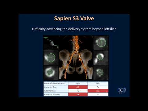 How I Managed a Difficult Sapien TAVR Case - M. Chadi Alraies, MD