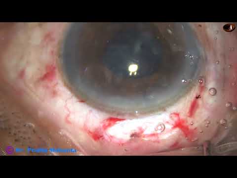 Phaco Training: Dr. Pradip Mohanta Demonstrates the use of B-Hex Pupil ...