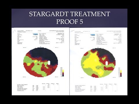 Stargardt Macular Dystrophy Treatment Proof – Visual Field Tests Results