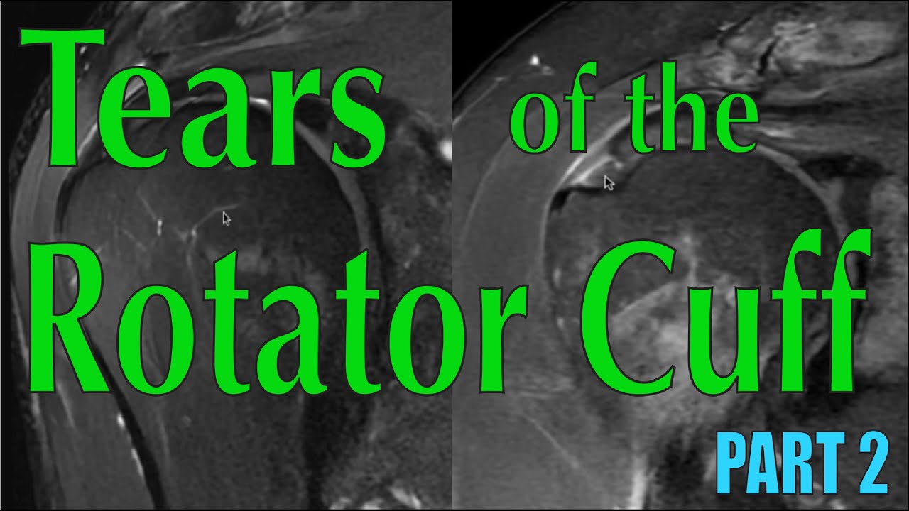 Understanding Rotator Cuff Tears: A Comprehensive Guide to MRI ...