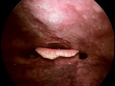 Videolaringoscopia ou Videoendoscopia laríngea