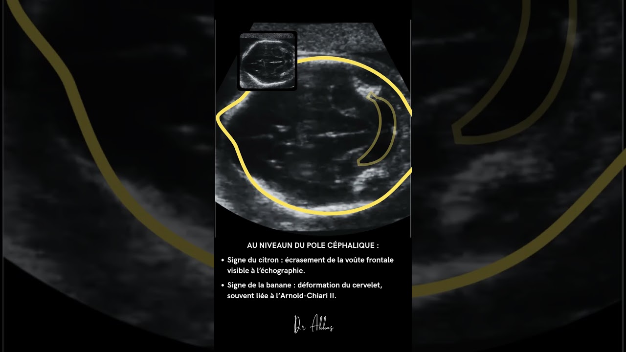 Spina bifida est une anomalie de fermeture du tube neural.