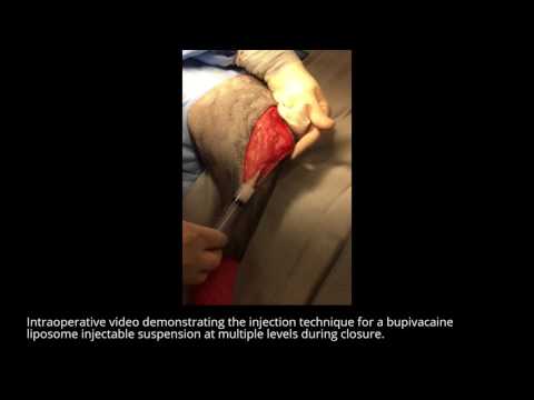 Bupivacaine liposome injectable suspension