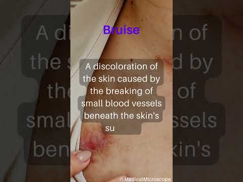 Bruise │ Selected medical terminology │ #medicalterminology #bruise #short