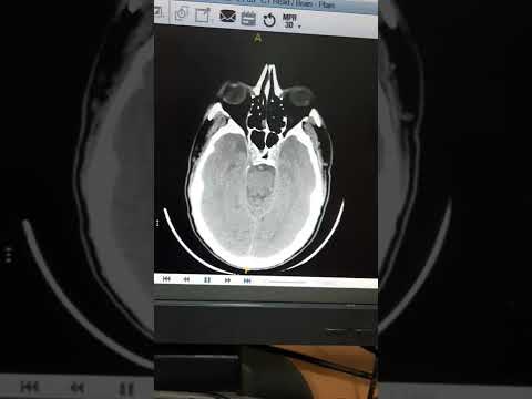 Sudden onset LOC , with low GCS