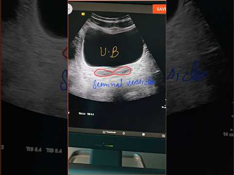 Seminal Vesicle on Ultrasound #Ultrasound #medical #disease #infection #doppler #health #shorts
