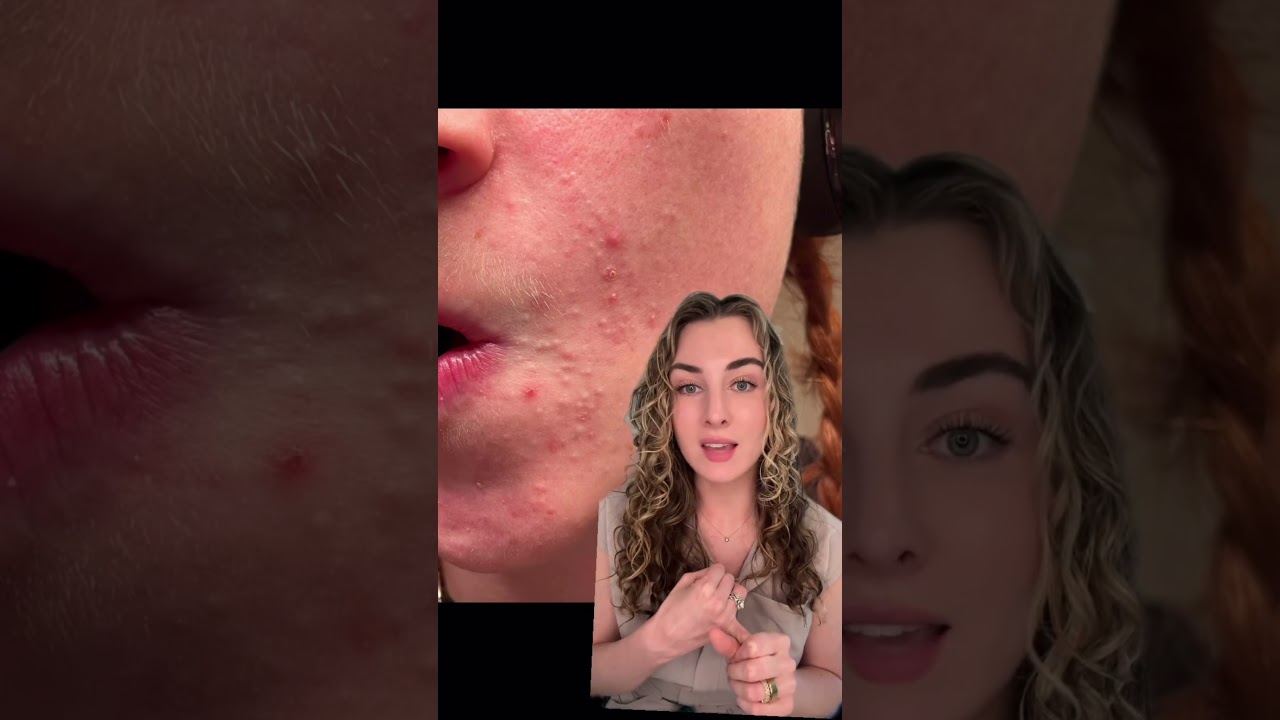 How to Treat Closed Comedones and Textured Acne the Right Way