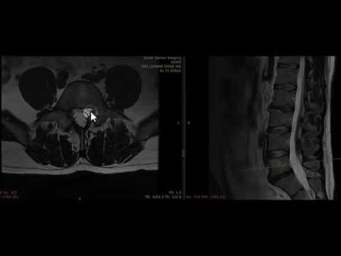 Find Specific Nerve Roots on a Lumbar MRI
