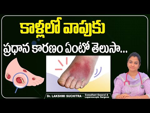 కాళ్ళు వాస్తున్నాయా || Symptoms Of Cellulitis In Telugu || Leg Infection Causes || Sankhya Hospitals